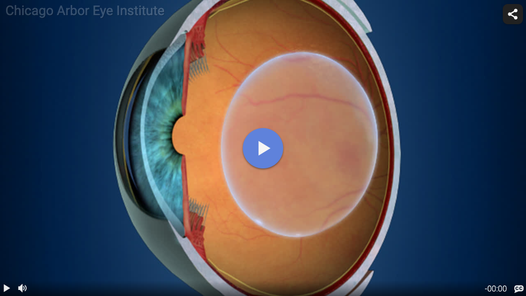 Refractive Lens Exchange Chicago | Vision Correction Chicago, IL